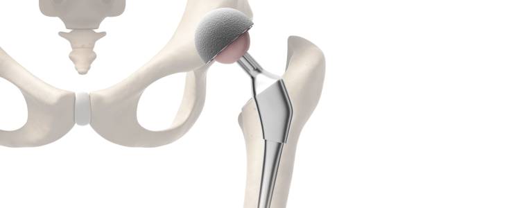 Krankengymnastik nach Hüft-TEP